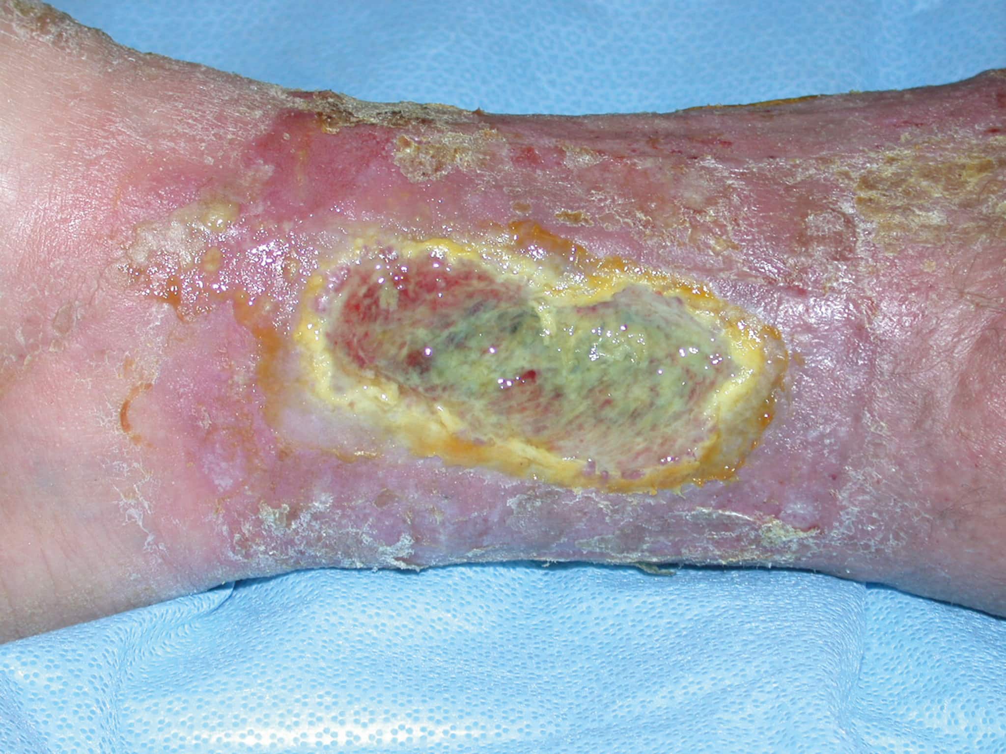 A venous leg ulcer (VLU) is an open skin wound, or lesion