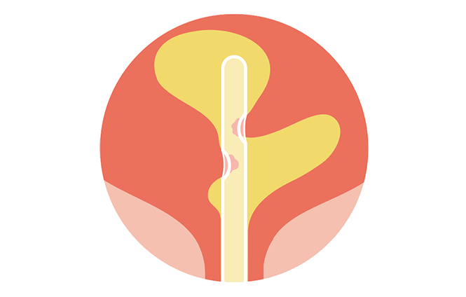 Bladder microtrauma